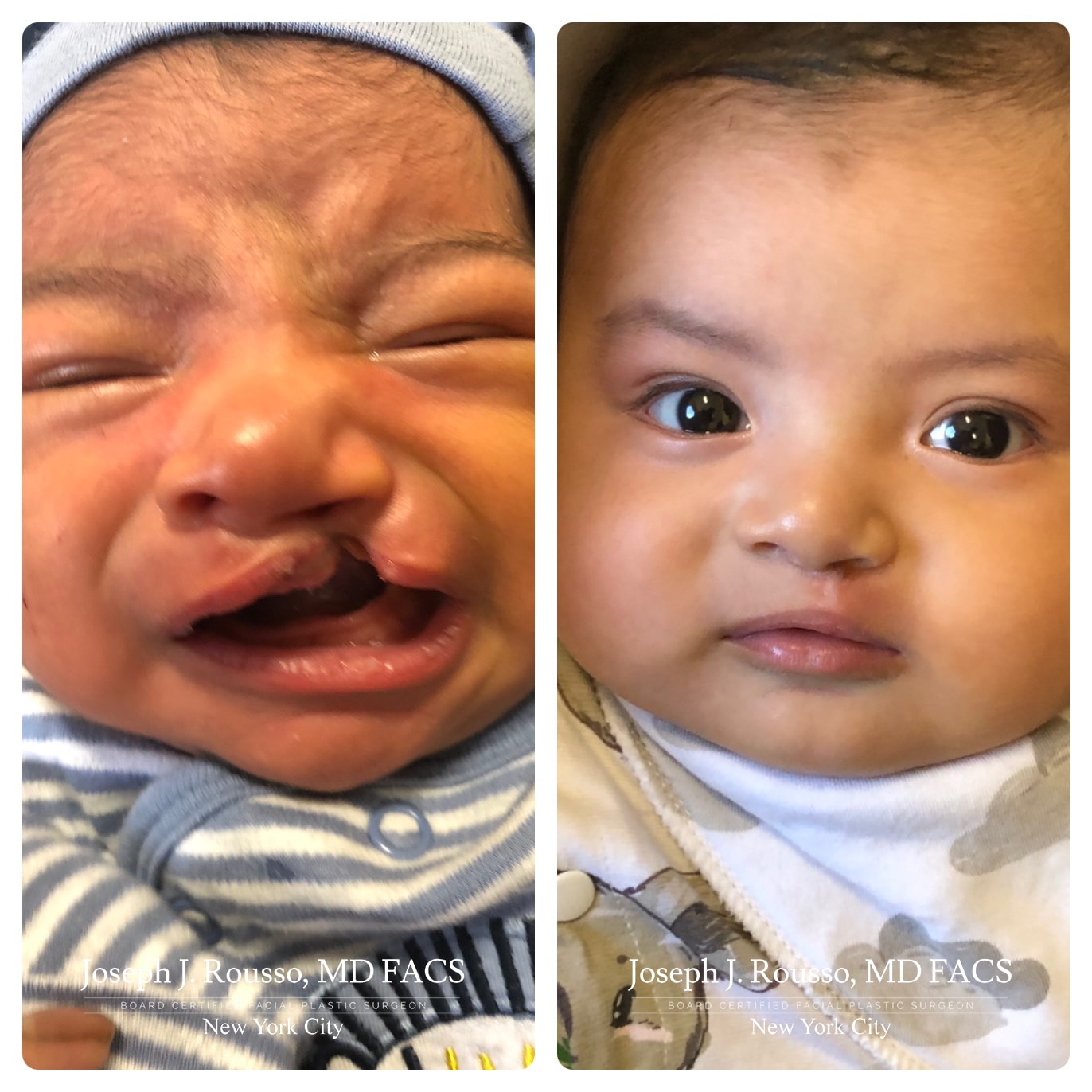 Cleft Rhinoplasty from a Plastic Surgeon | New York, NY